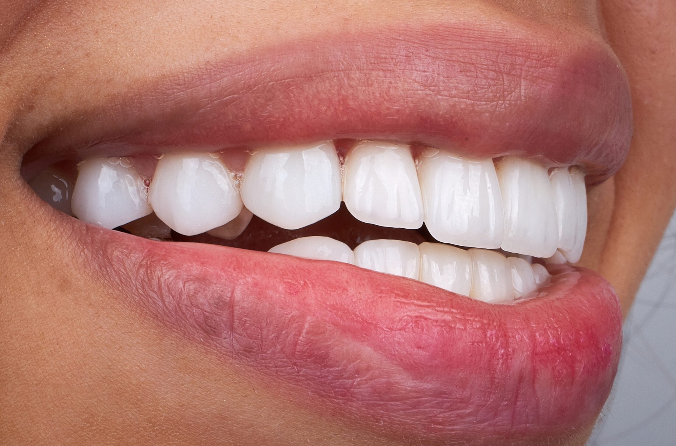 Accelerated Orthodontic Surgery: Achieve Results Fast - Palm Beach ...